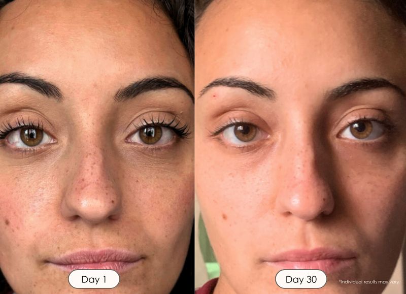 Reinvo | Facial Microdermabrasion Wand | Project E Beauty